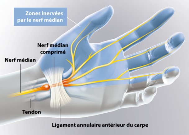 Syndrome du canal carpien | Clinique Maussins Nollet